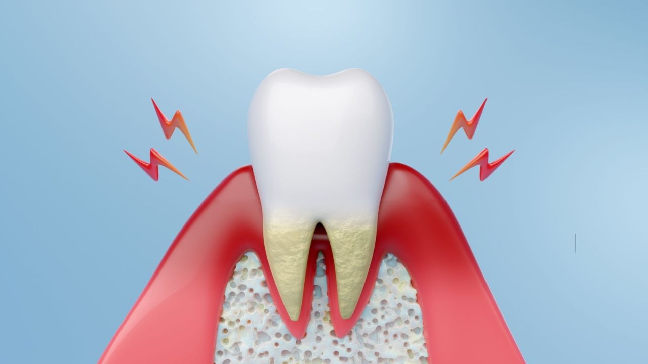 Periodontite Apical: - Instituto Caiado - Odontologia
